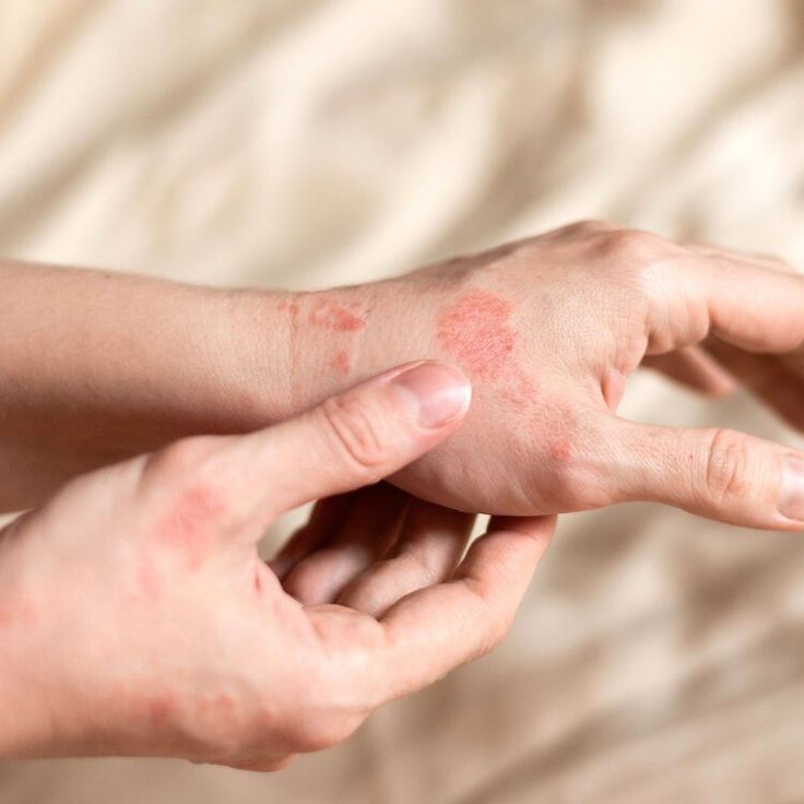 Understanding Eczema: How Stress Affects Your Skin – Tadheen